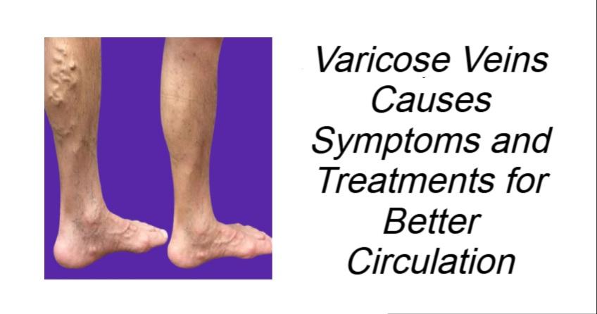 Varicose Veins Causes Symptoms and Treatments